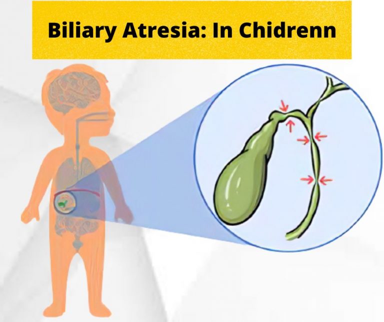 Biliary Atresia in children - Causes & Treatment | Dr.Vishesh Dikshit